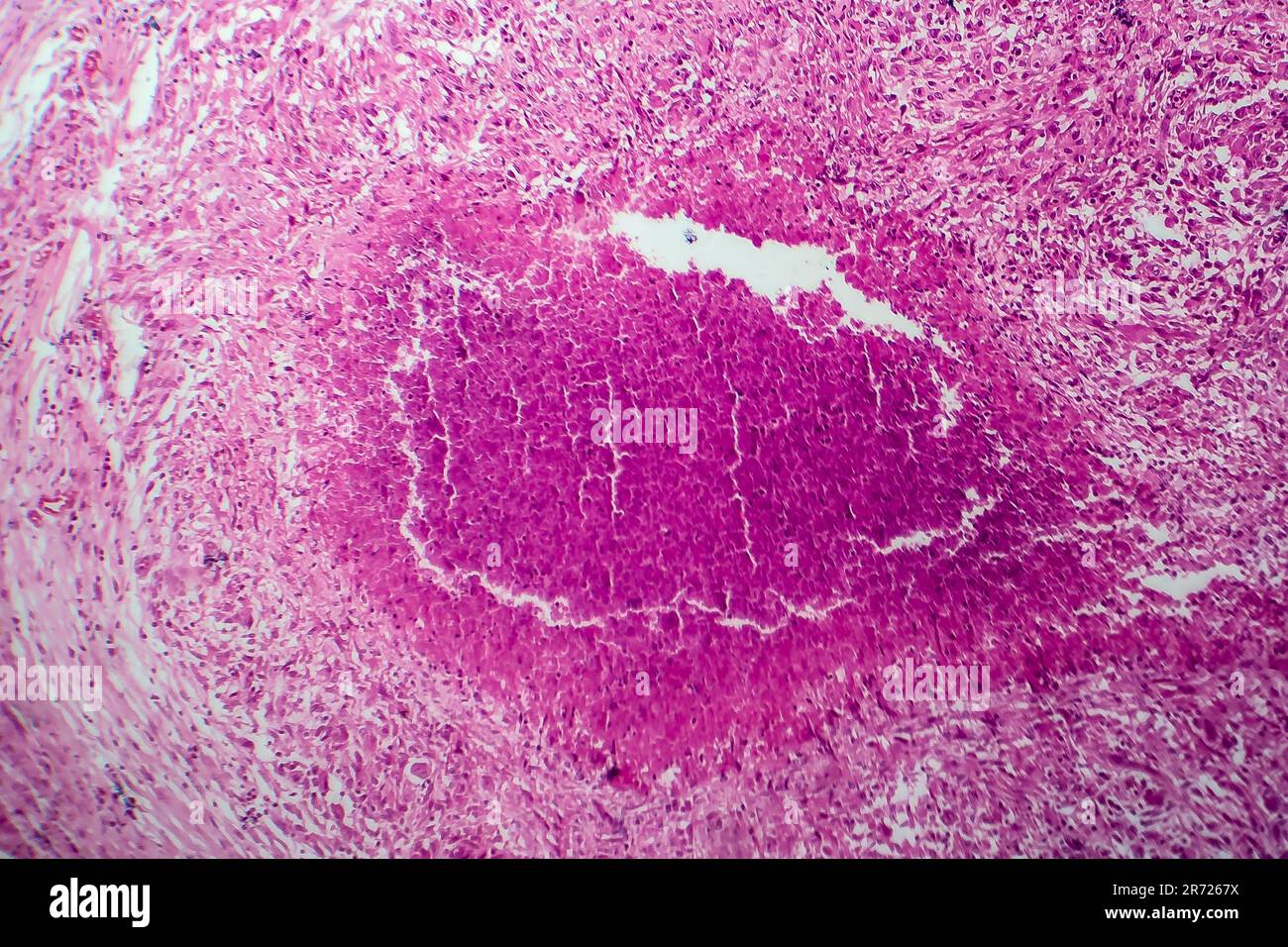 Renal tuberculosis, light micrograph, photo under microscope Stock ...