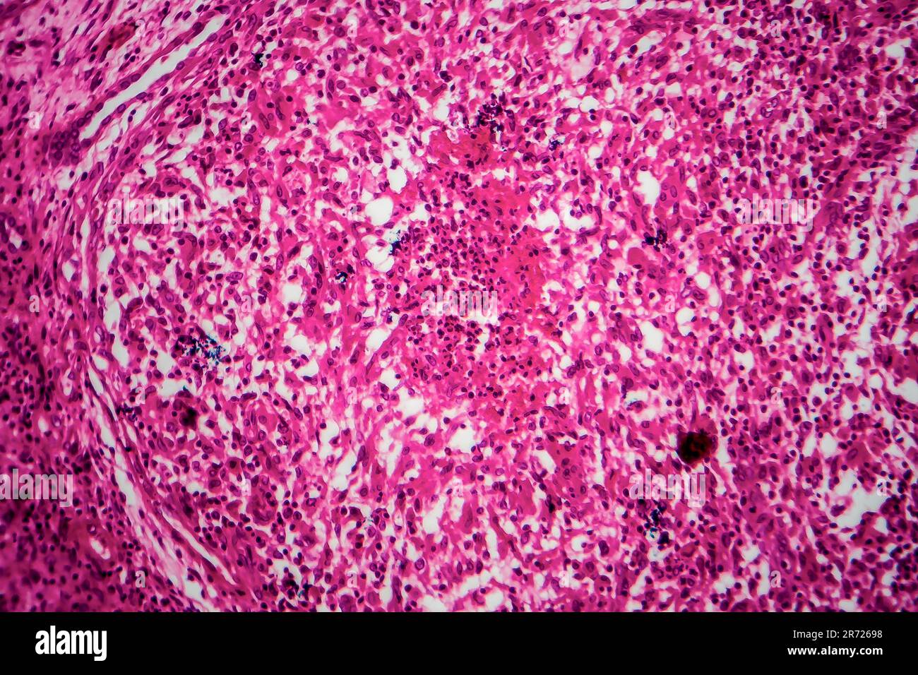 Renal tuberculosis, light micrograph, photo under microscope Stock ...