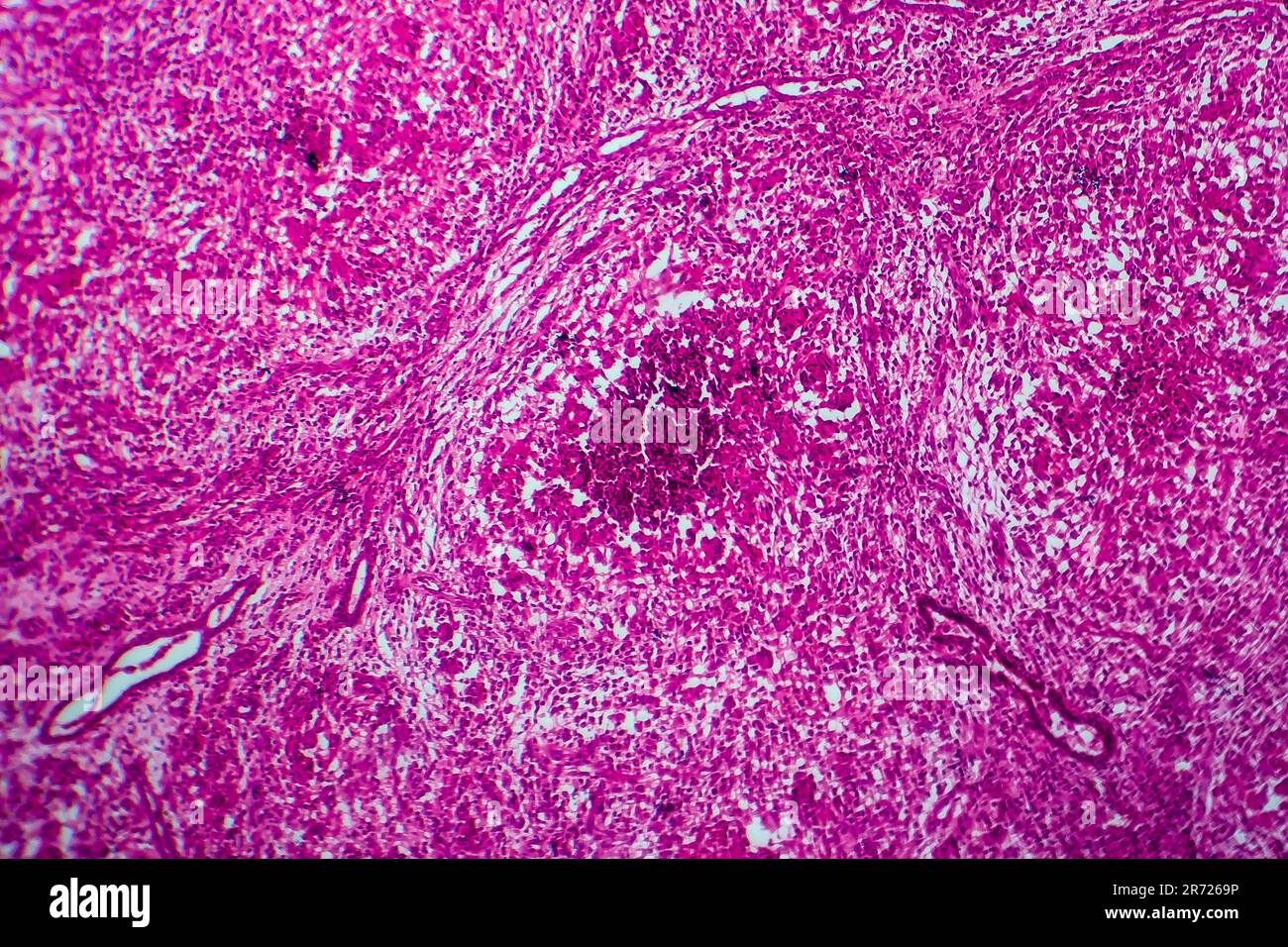 Renal tuberculosis, light micrograph, photo under microscope Stock ...