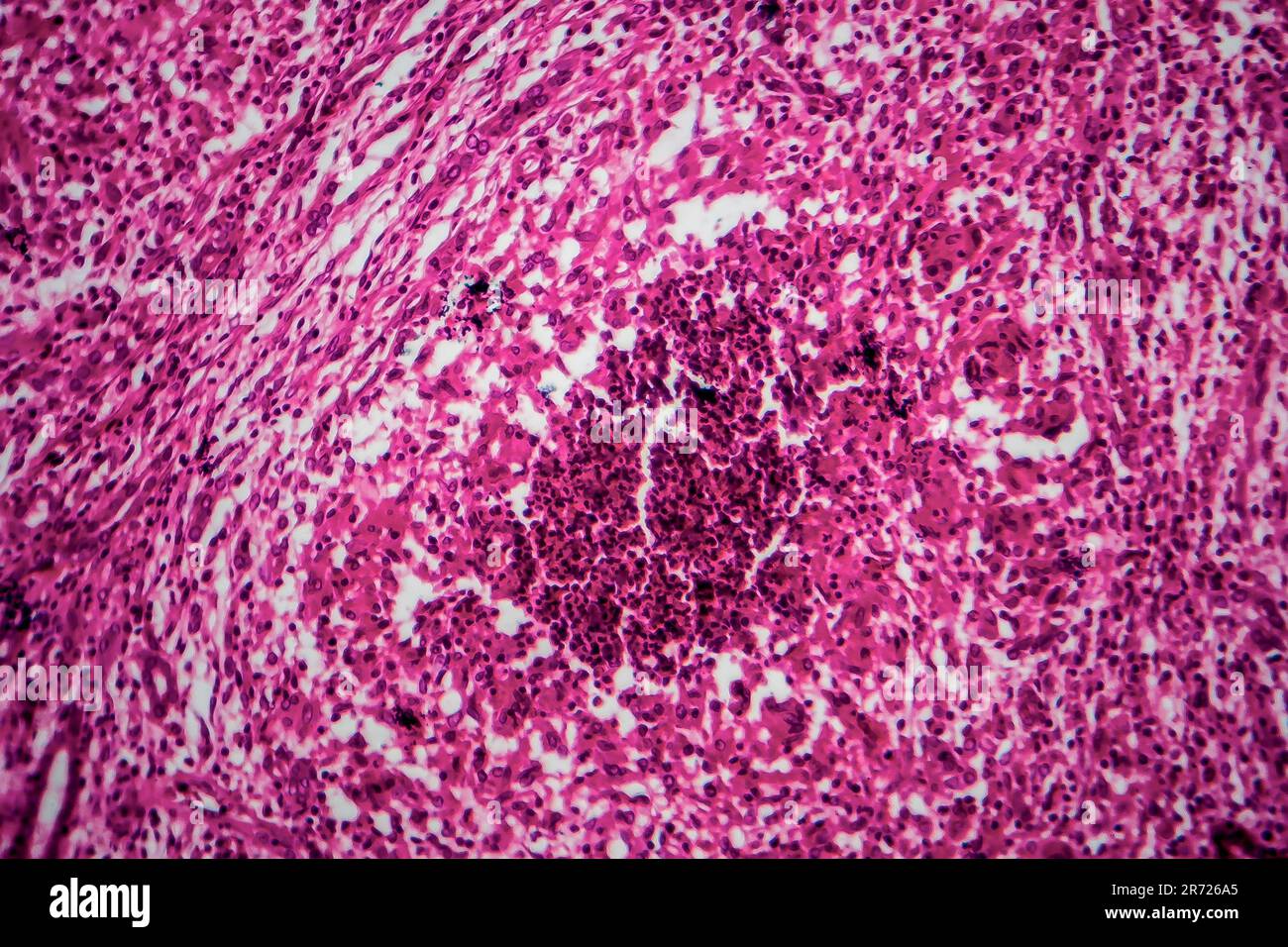 Renal tuberculosis, light micrograph, photo under microscope Stock ...