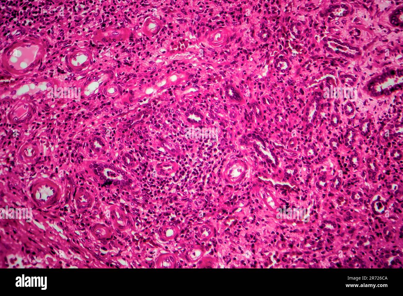 Renal tuberculosis, light micrograph, photo under microscope Stock ...