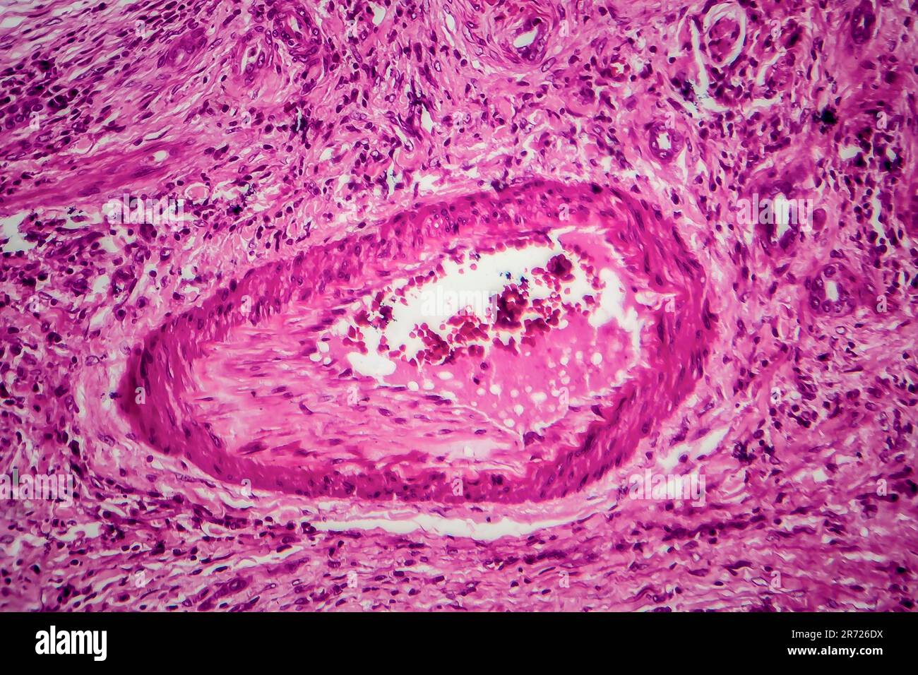Renal tuberculosis, light micrograph, photo under microscope Stock ...