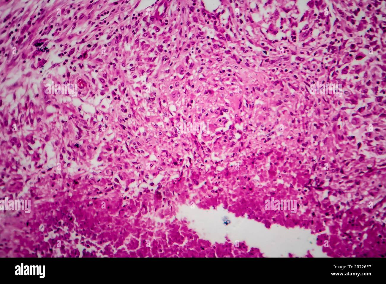 Renal tuberculosis, light micrograph, photo under microscope Stock ...