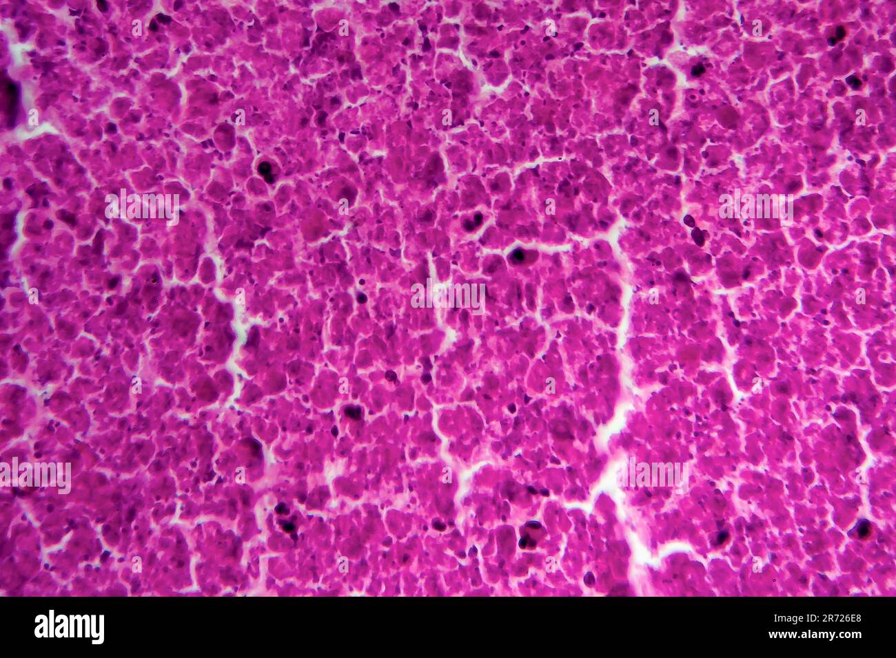 Renal tuberculosis, light micrograph, photo under microscope Stock ...