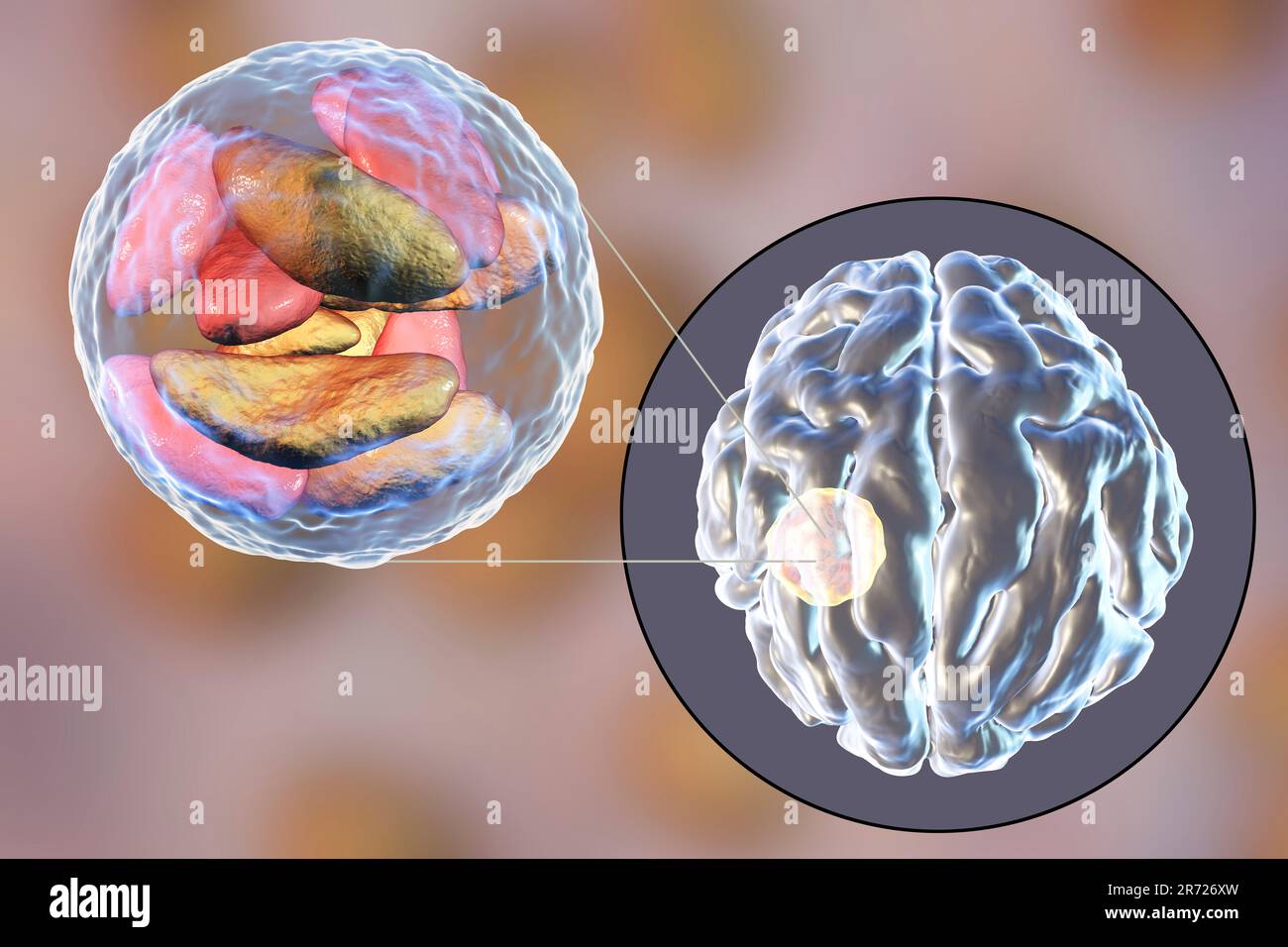 Neurotoxoplasmosis, brain abscess caused by parasitic protozoan ...