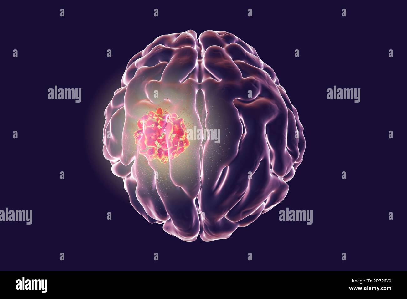 Conceptual image for brain cancer treatment. Computer illustration ...