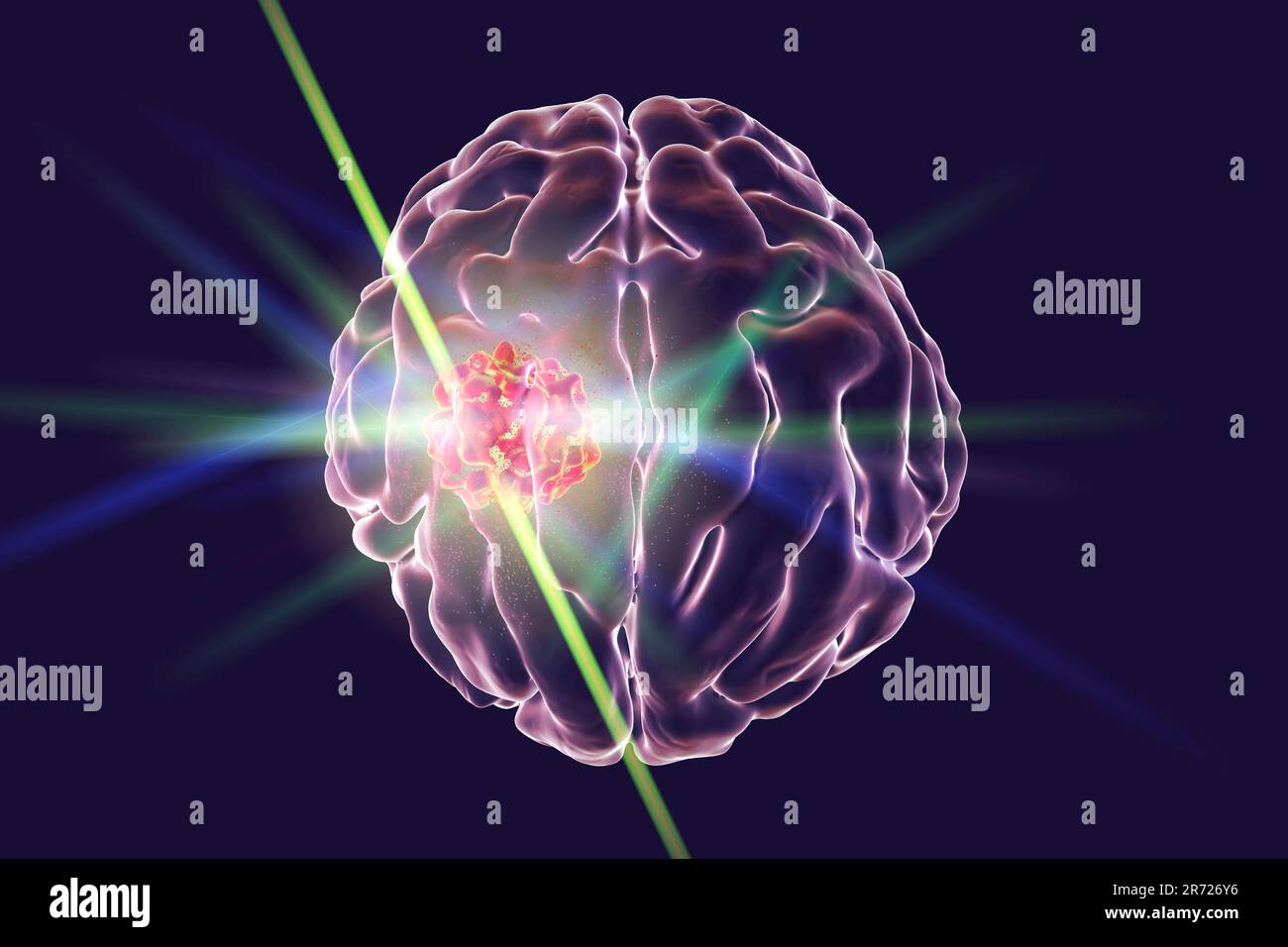 Conceptual image for brain cancer treatment. Computer illustration ...