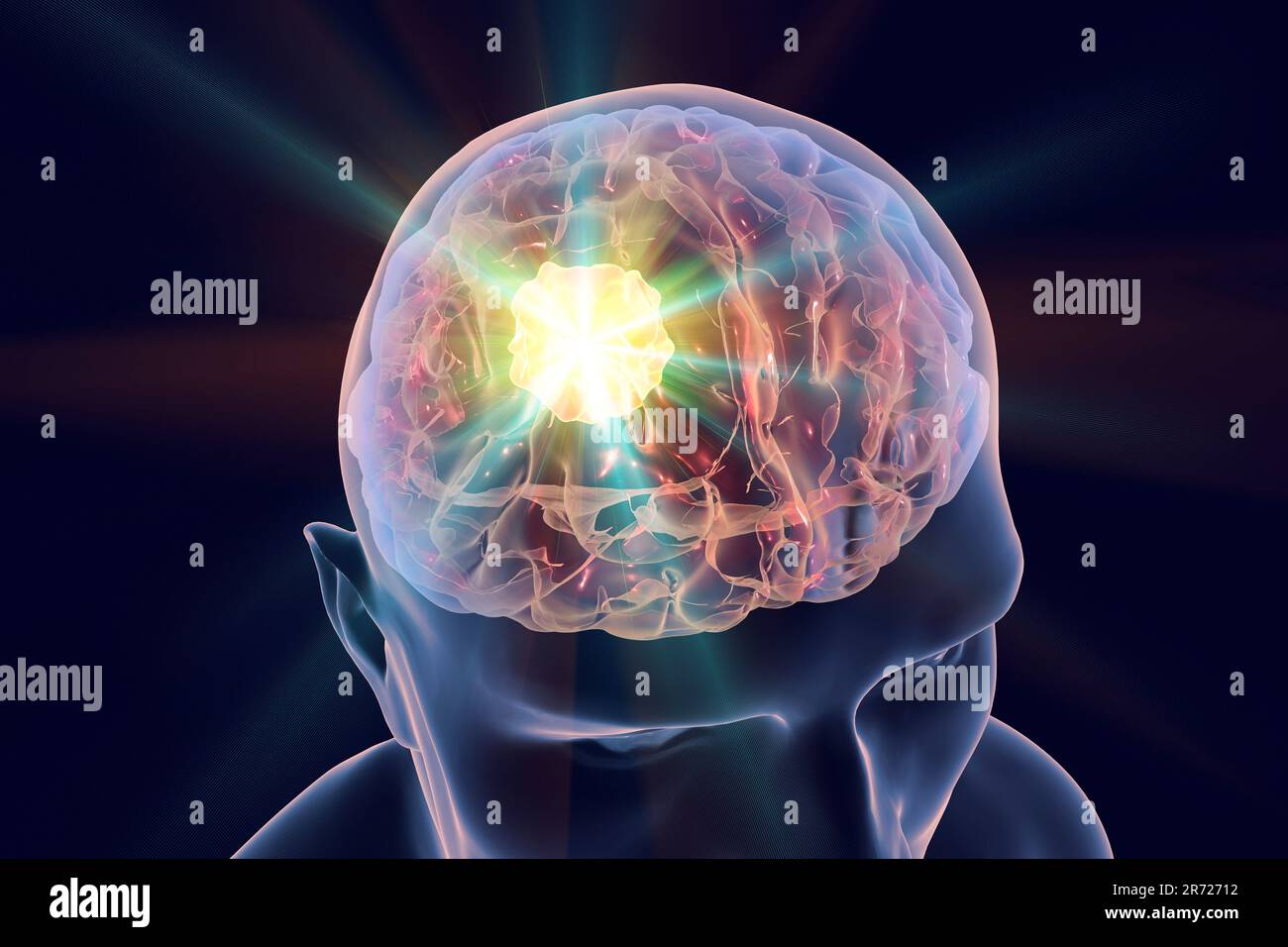 Conceptual image for brain cancer treatment. Computer illustration ...