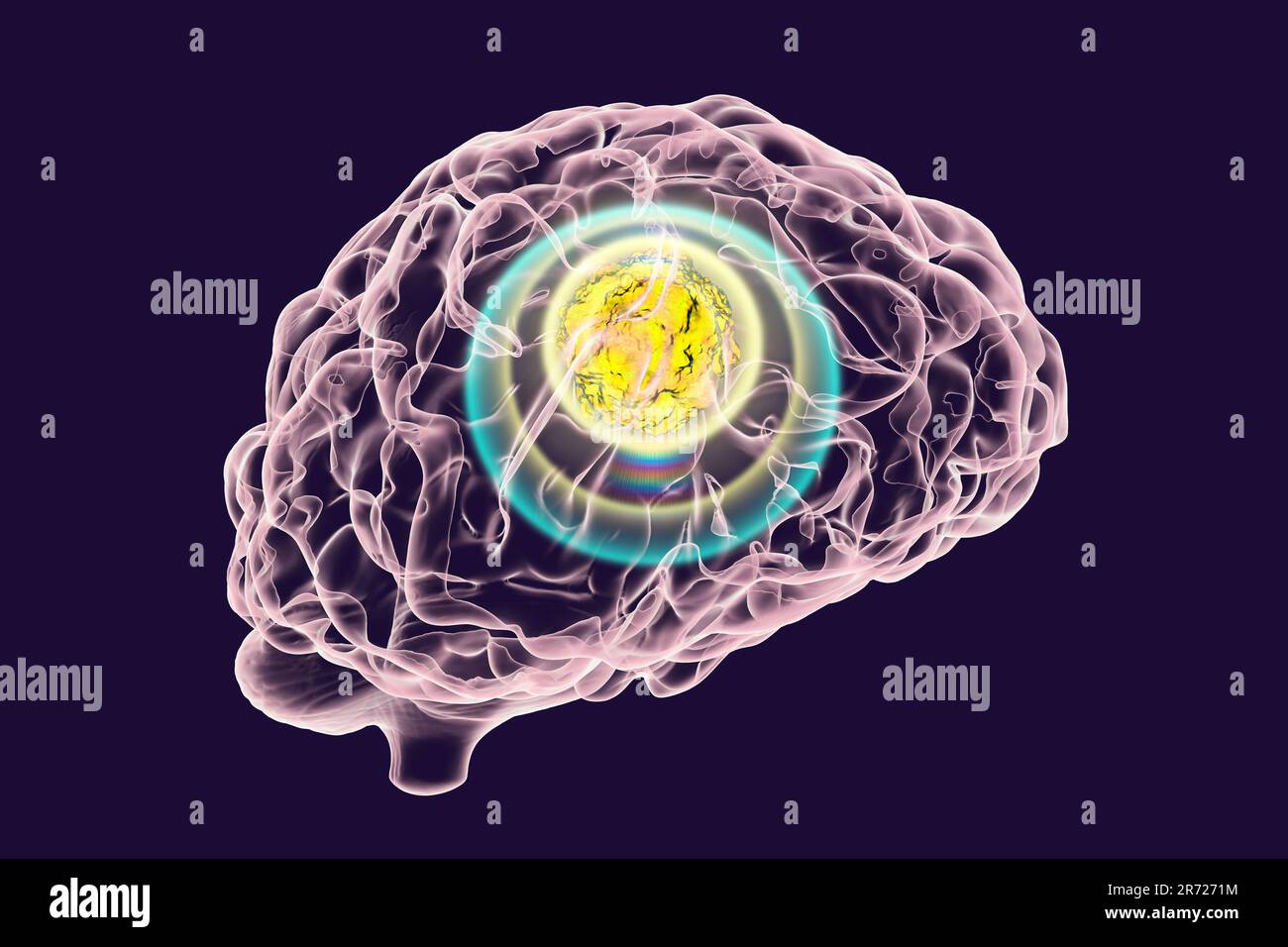 Conceptual image for brain cancer treatment. Computer illustration ...