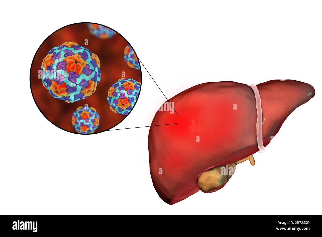 Liver with hepatitis and close-up view of hepatitis A viruses ...