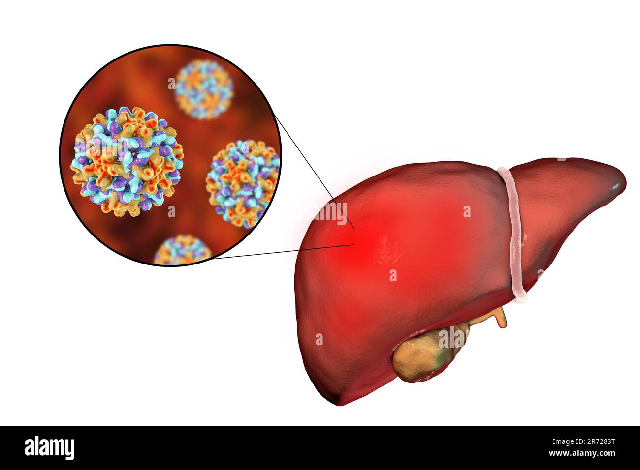 Liver with hepatitis and close-up view of hepatitis B viruses ...