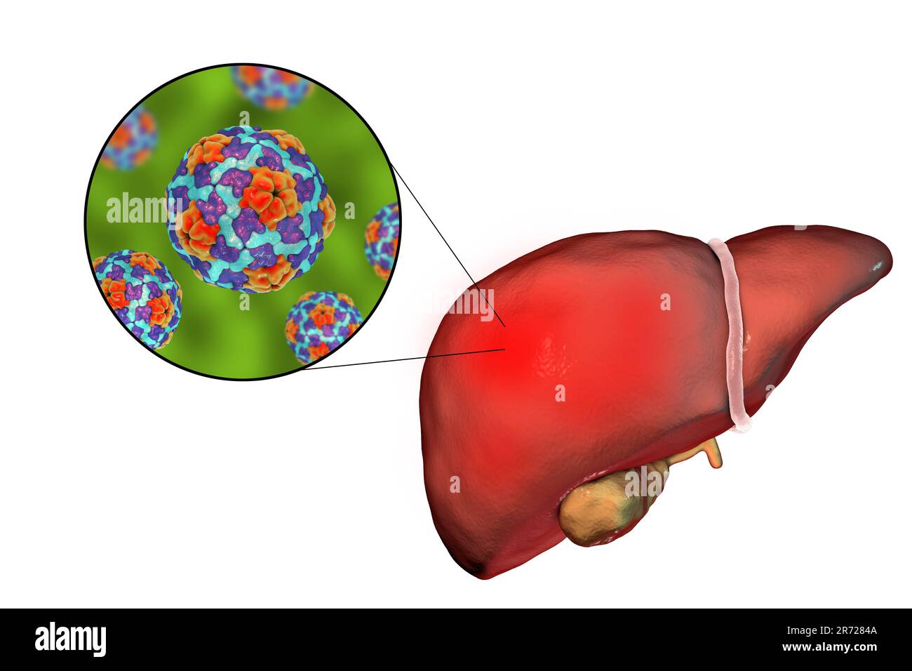 Liver with hepatitis and close-up view of hepatitis A viruses ...