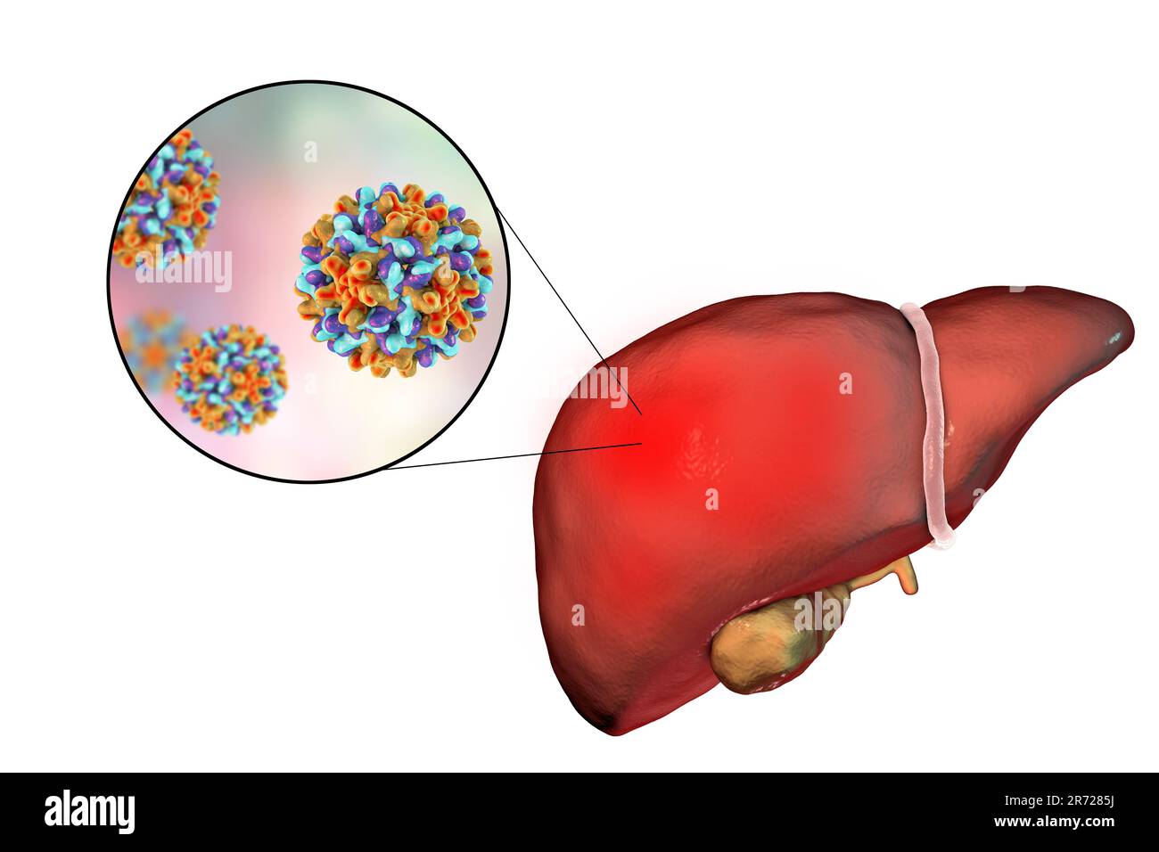 Liver with hepatitis and close-up view of hepatitis B viruses ...