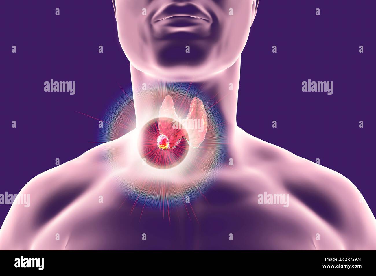 Destruction of thyroid tumor, computer illustration. Conceptual image ...