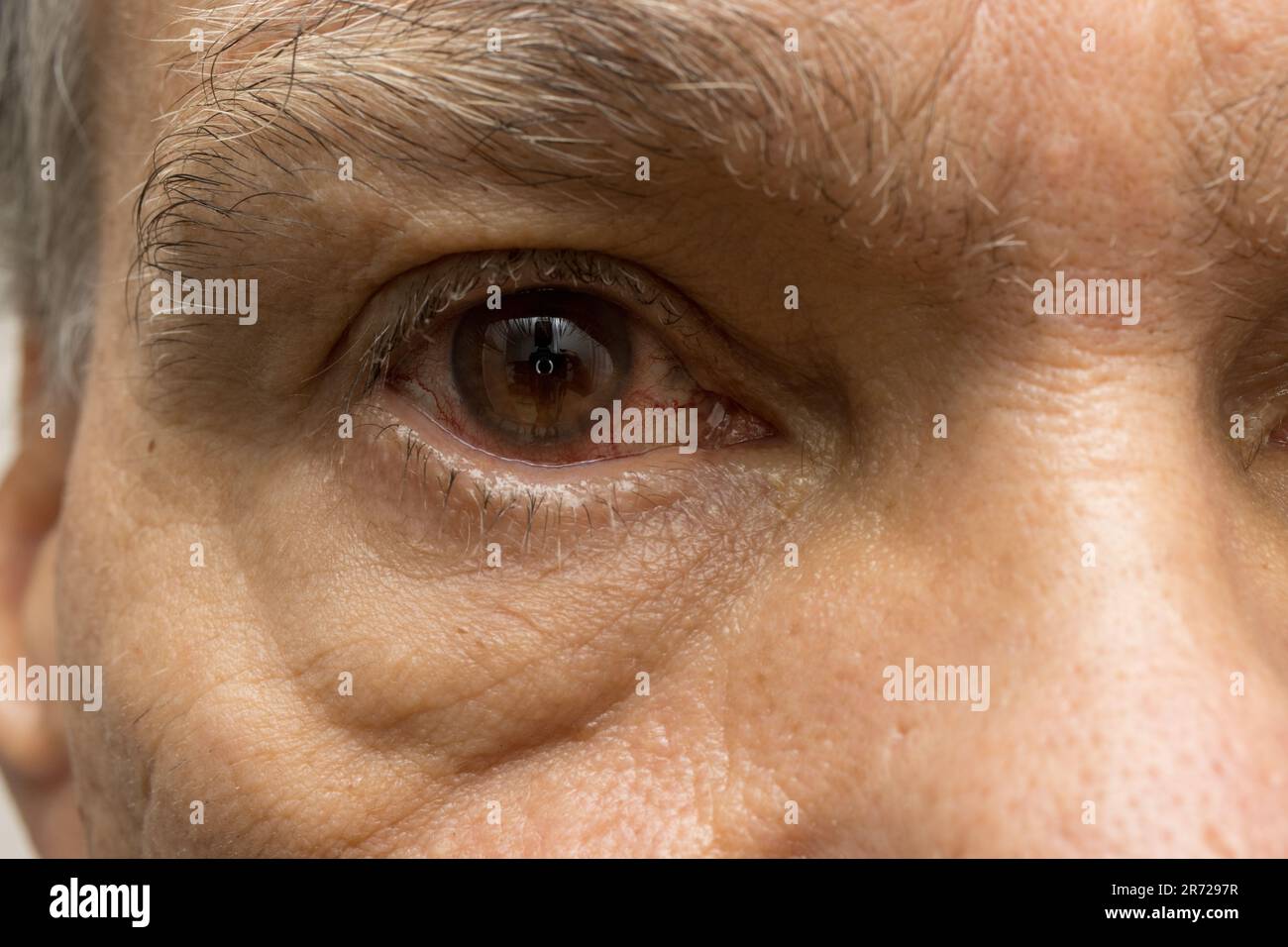 Man red eyes irritation hi-res stock photography and images - Alamy