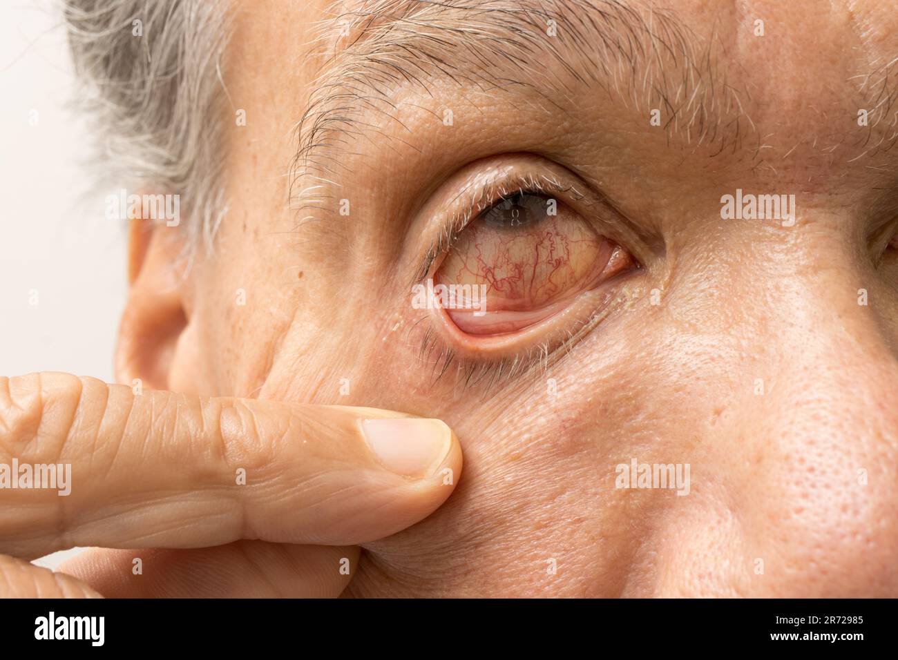 Man red eyes irritation hi-res stock photography and images - Alamy