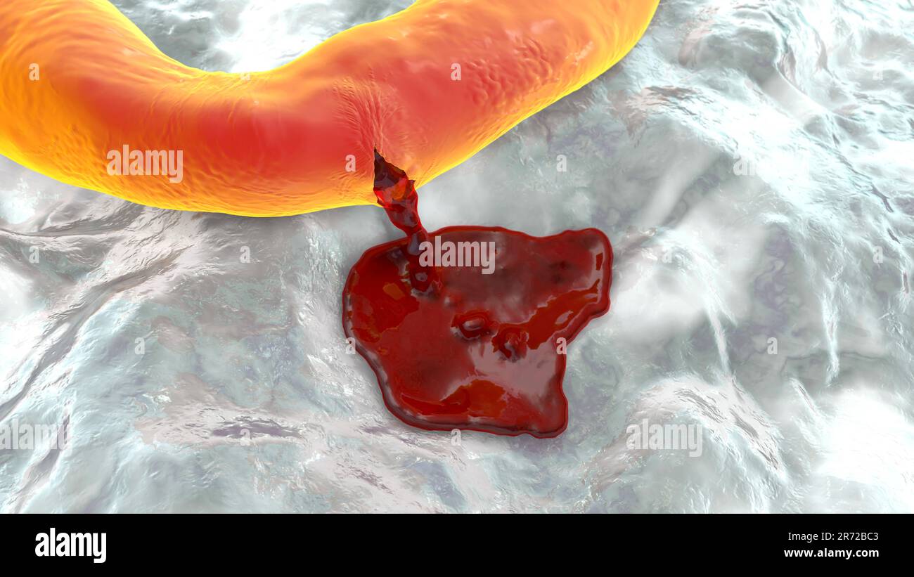 Hemorrhage, blood flowing from the damaged blood vessel, 3D ...