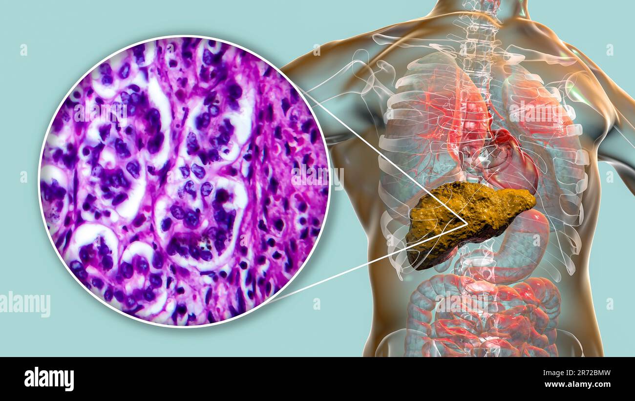 "Liver cirrhosis, computer illustration and light micrograph of a ...