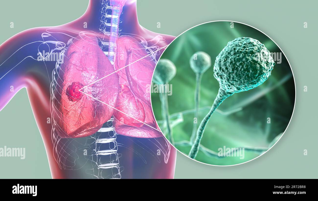 Pulmonary mucormycosis (or zygomycosis), a lung disease caused by fungi ...