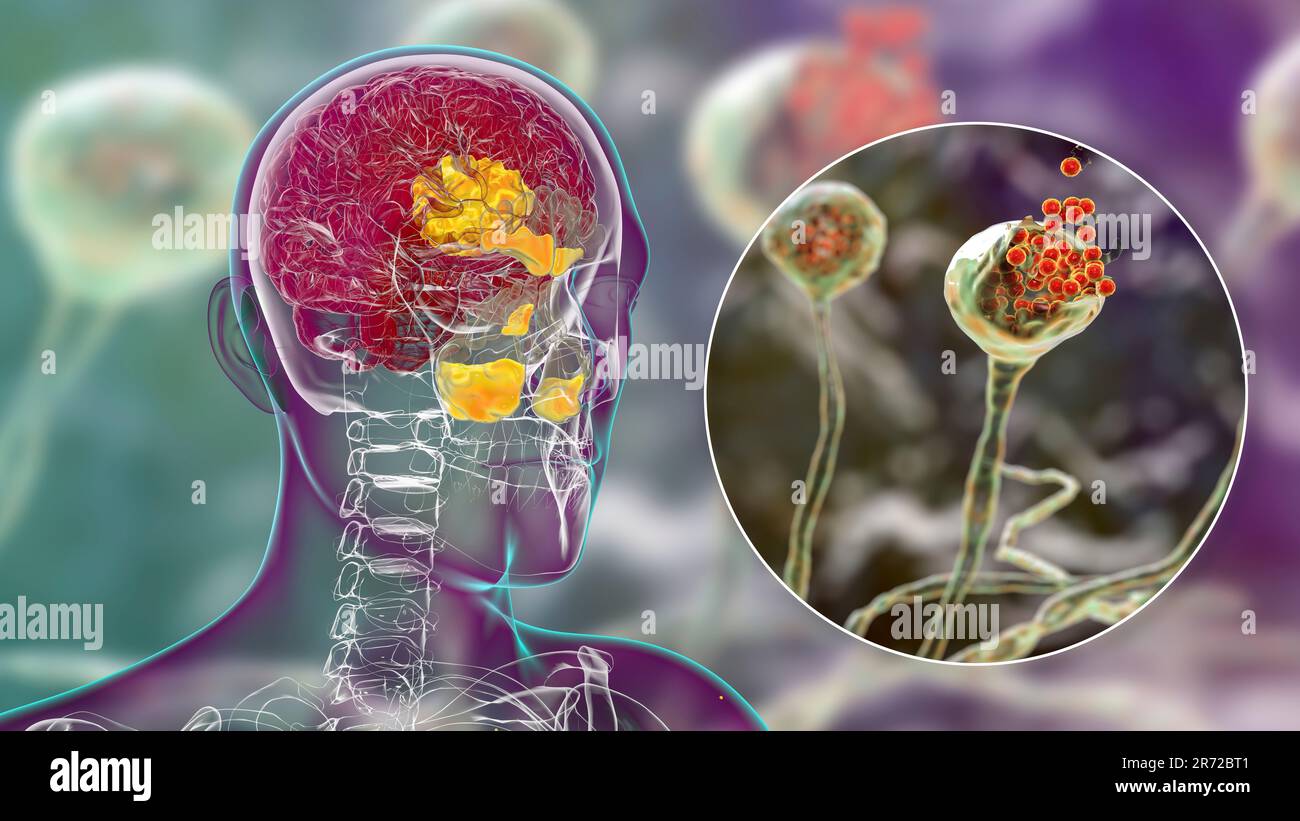 Rhinocerebral mucormycosis (or zygomycosis), a brain lesion and ...