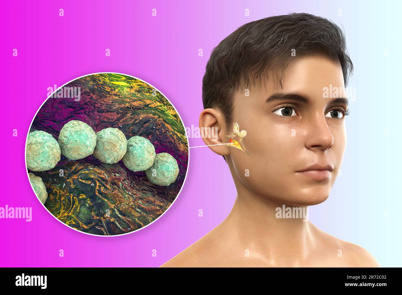 Streptococcus pyogenes bacterium as a cause of otitis media. Computer ...