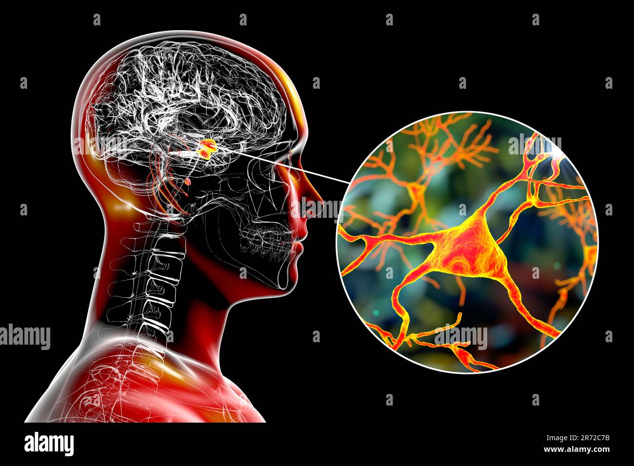 Amygdala in the brain, and closeup view of amygdala neurons, computer ...