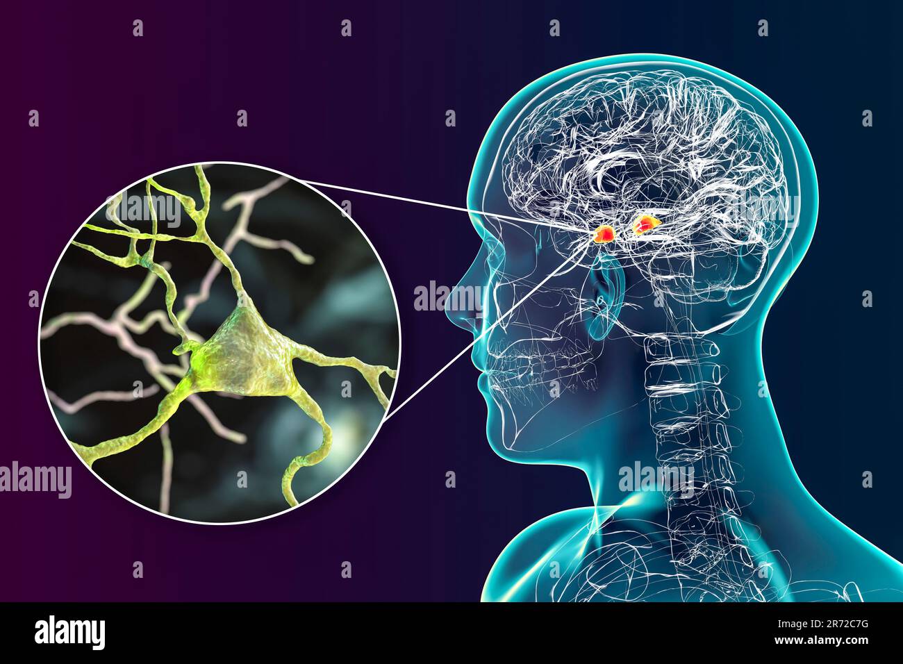 Amygdala in the brain, and closeup view of amygdala neurons, computer ...