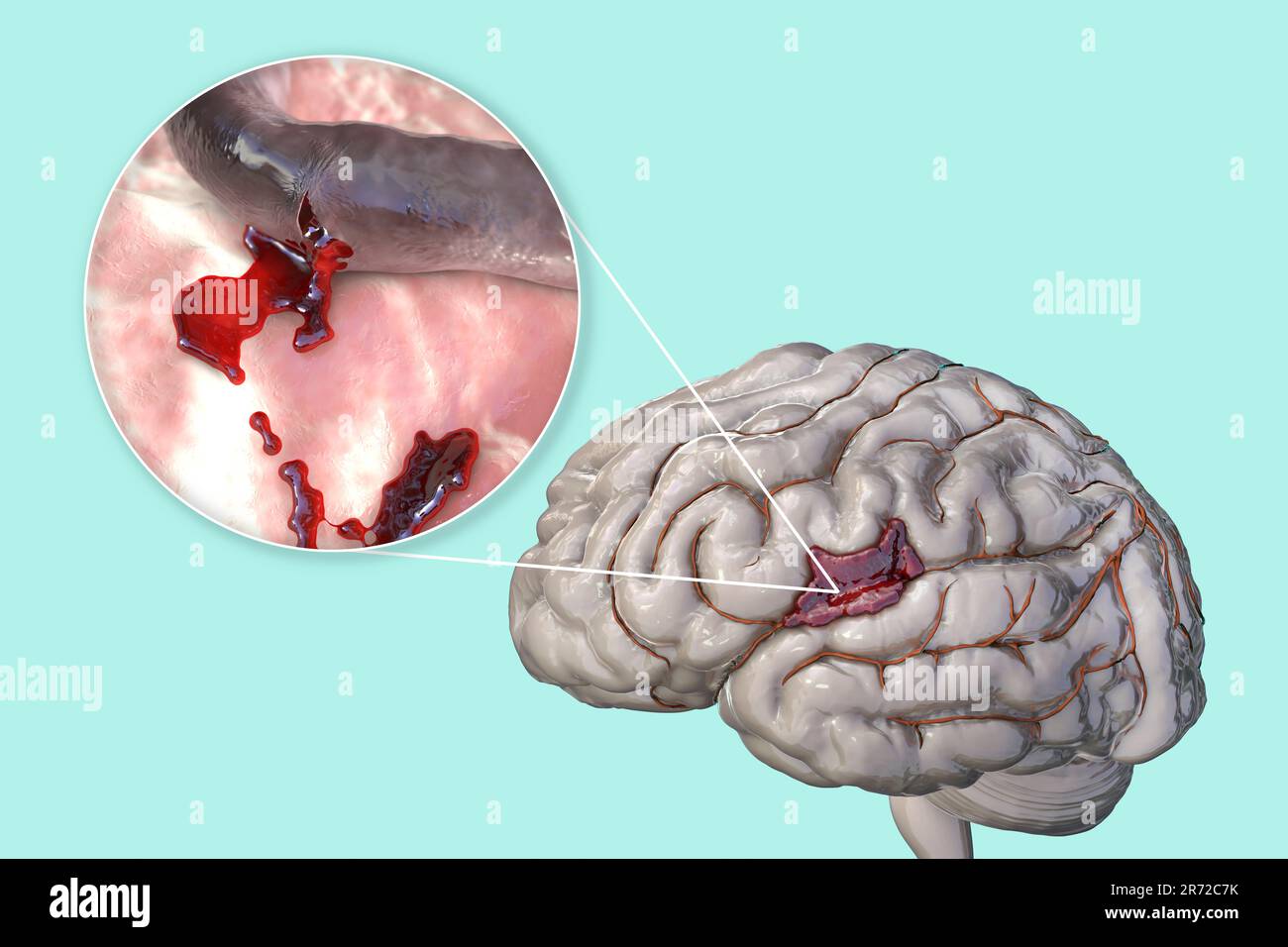 Haemorrhagic stroke. Illustration of a ruptured blood vessel in the ...