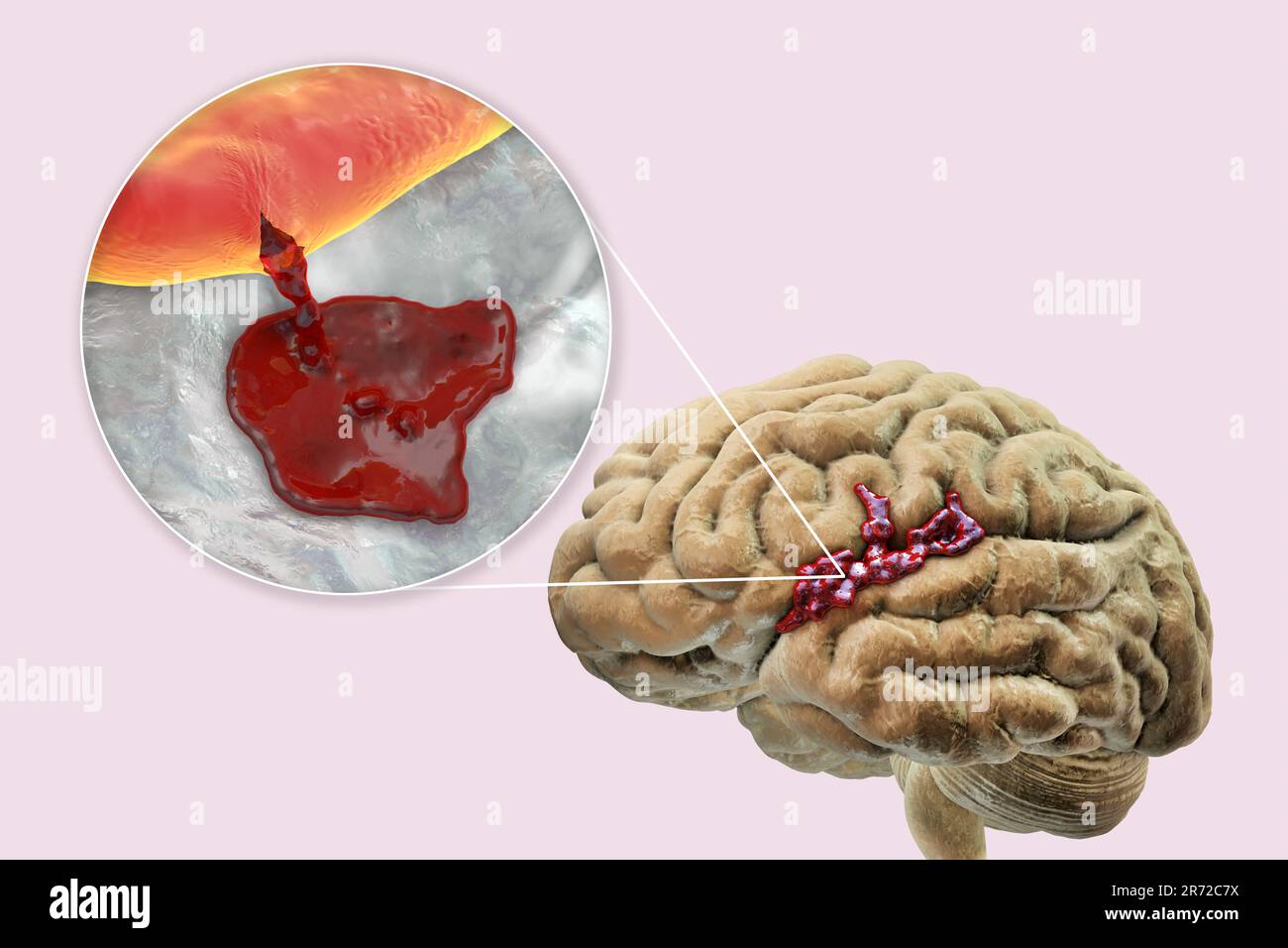 Haemorrhagic stroke. Illustration of a ruptured blood vessel in the ...