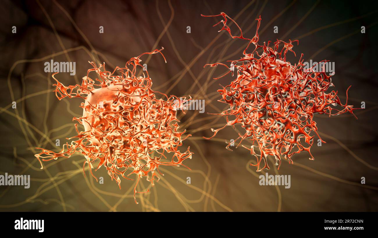 Cervical cancer cells, computer illustration Stock Photo - Alamy