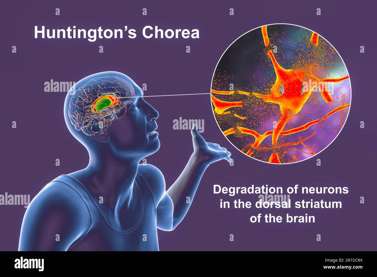 Dorsal striatum, caudate nucleus and putamen, highlighted in the brain ...