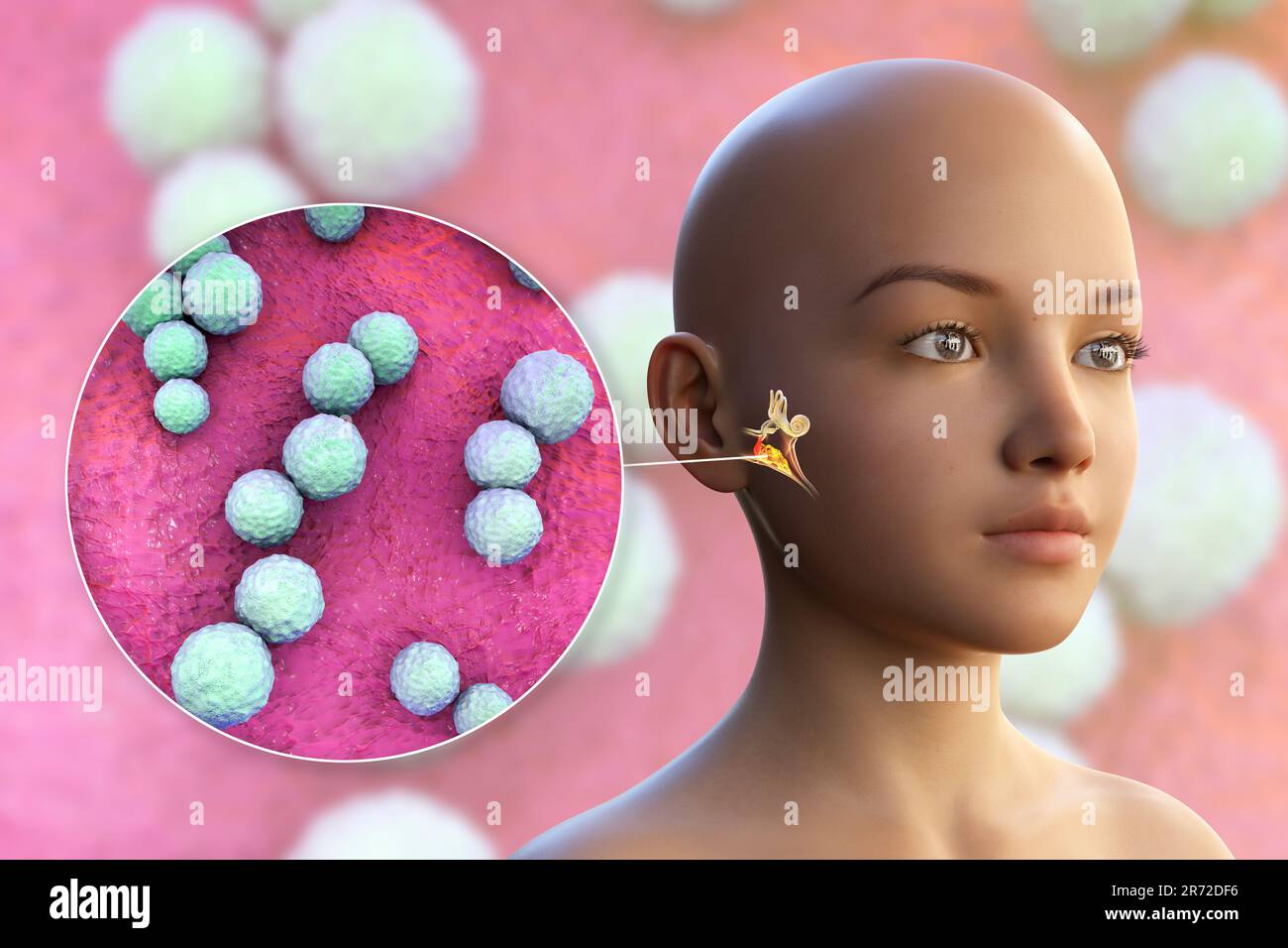 Streptococcus bacterium as a cause of otitis media. 3D illustration ...