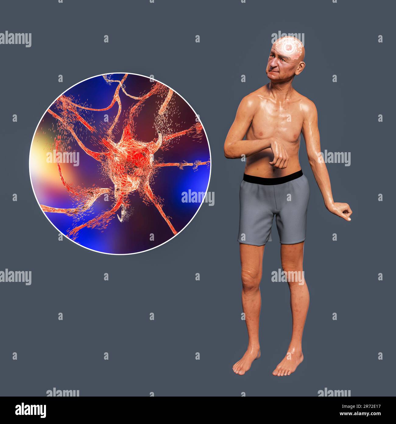 A person with chorea disease and close-up view of neuronal degradation ...
