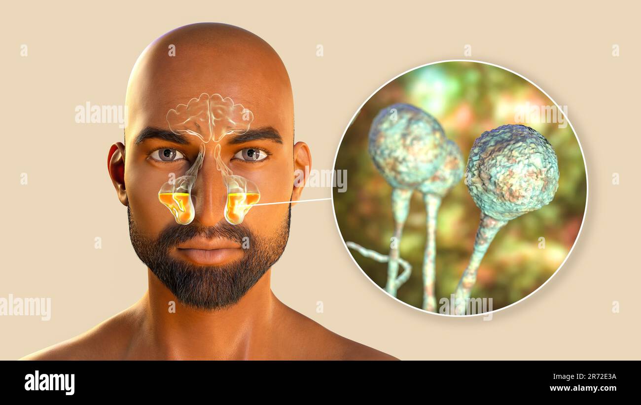 Mucor fungi as a cause of sinusitis, computer illustration ...