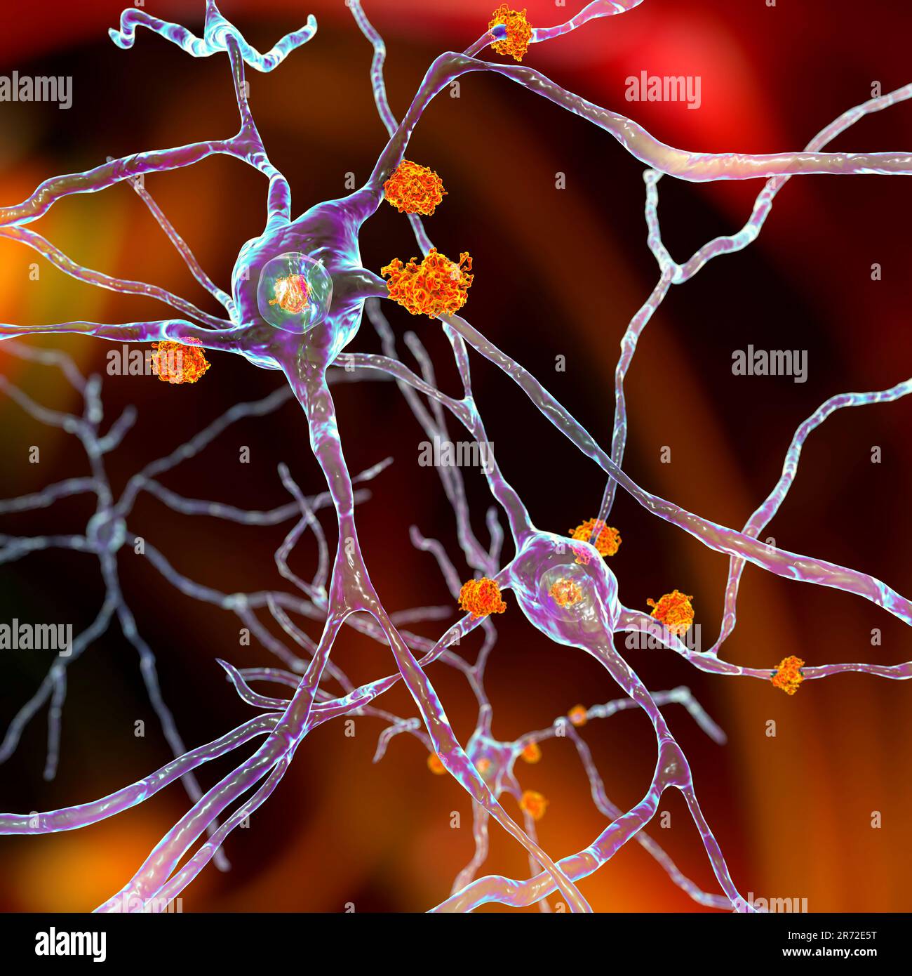 Neuronal inclusions in Huntington's disease, computer illustration ...