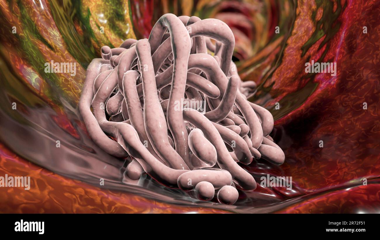 Round worms in human intestine, computer artwork. Roundworms, or ...
