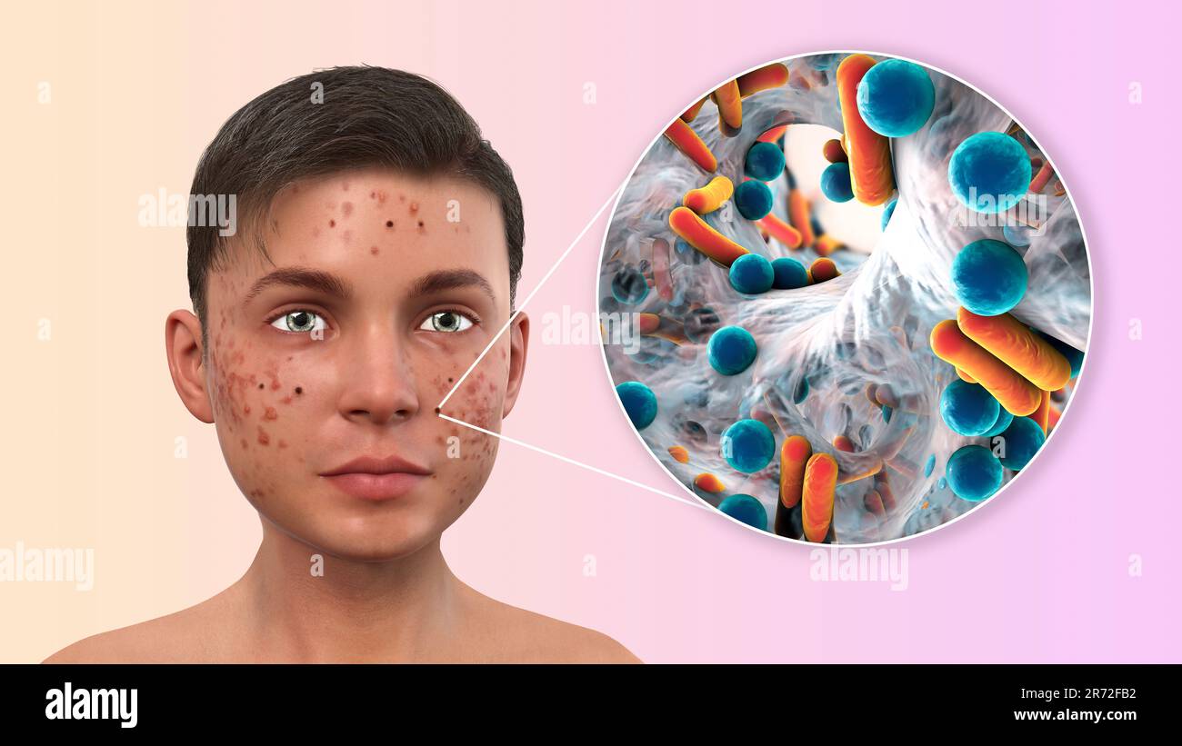 Acne vulgaris on a teenage boy's face and close-up view of bacteria ...