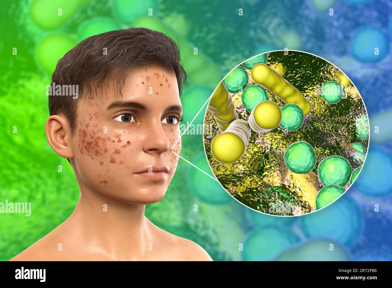 Acne vulgaris on a teenage boy's face and close-up view of bacteria ...