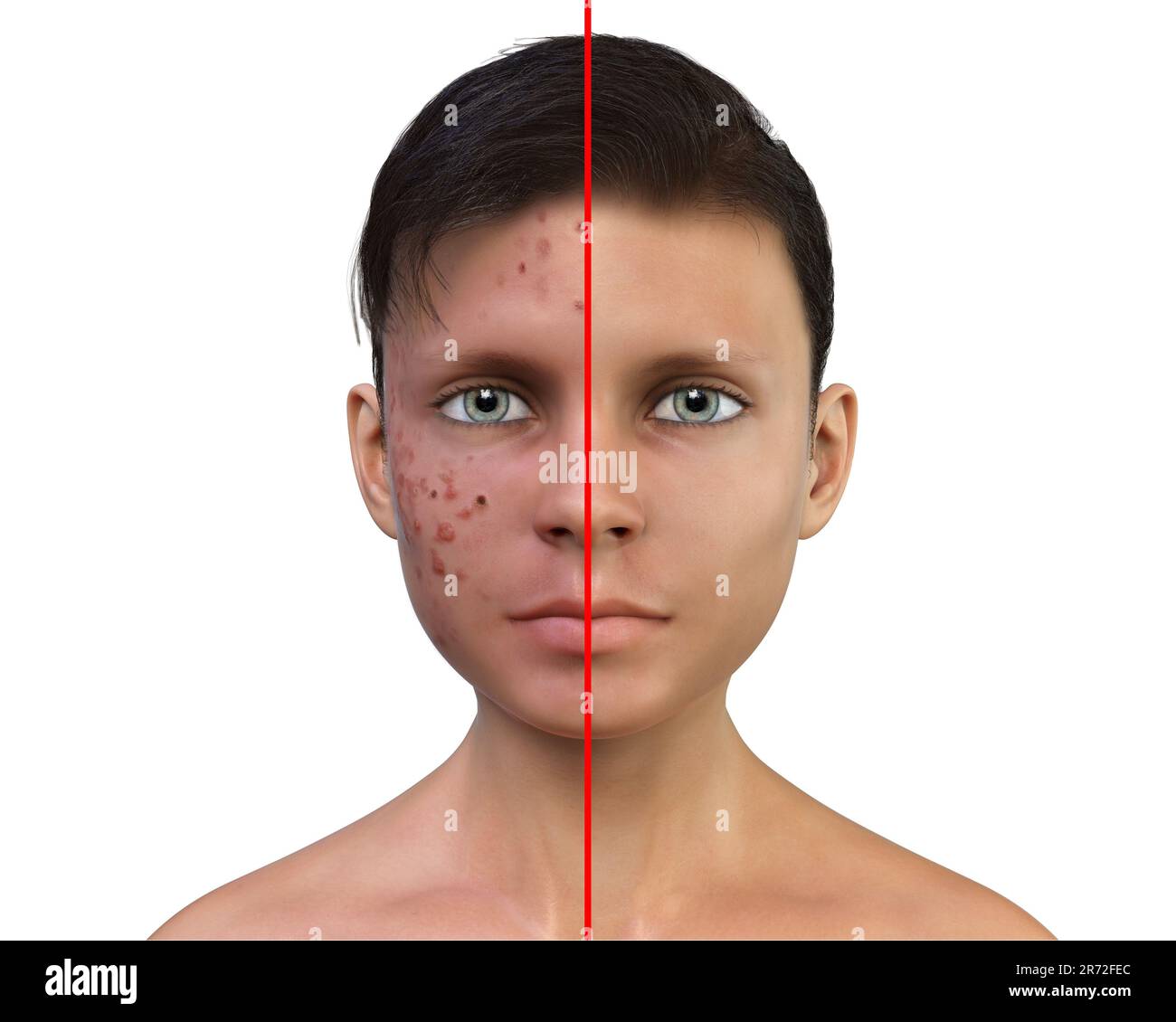 Acne vulgaris on a teenage boy's face, computer illustration showing ...