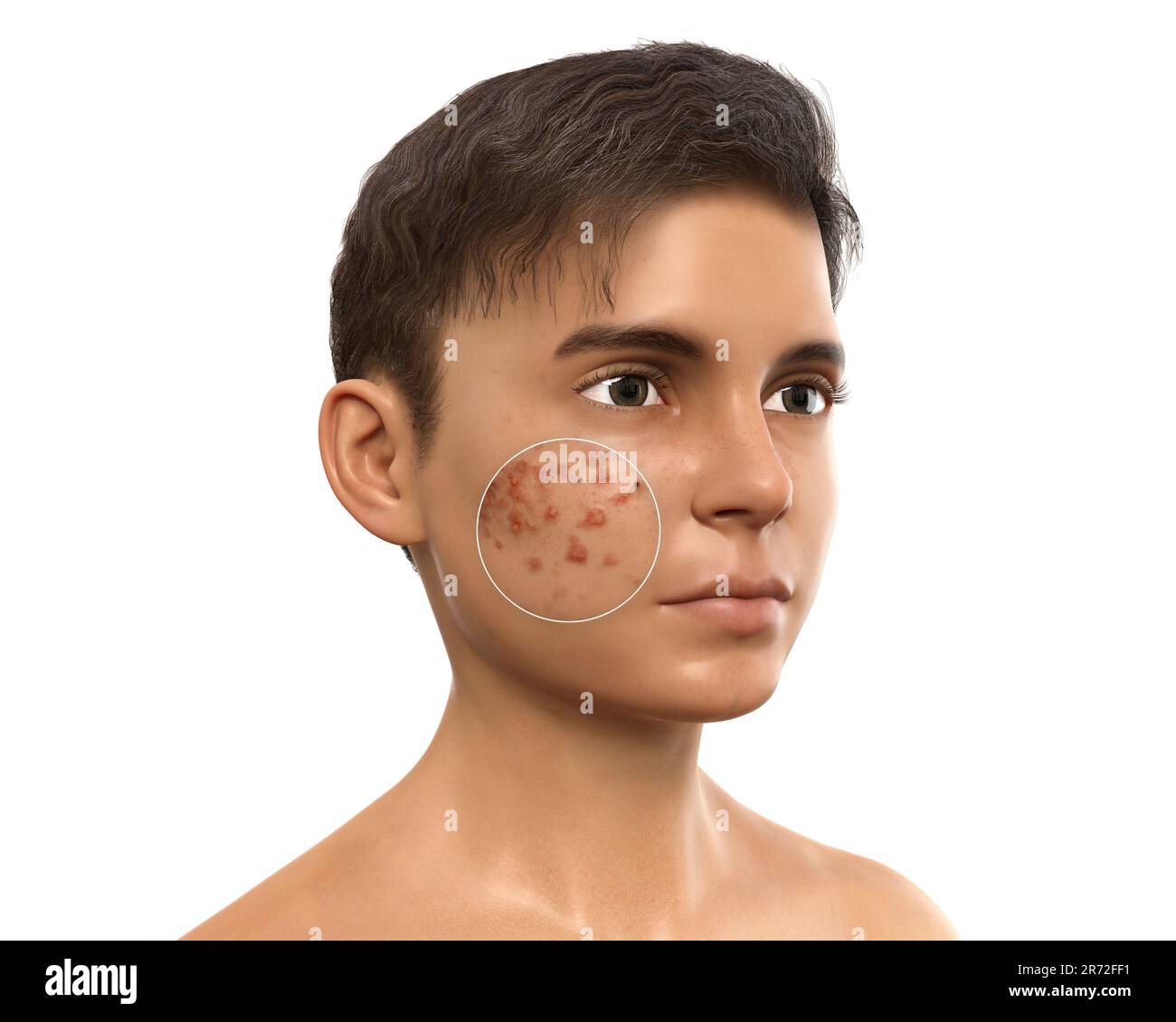 Acne vulgaris on a teenage boy's face, computer illustration showing ...