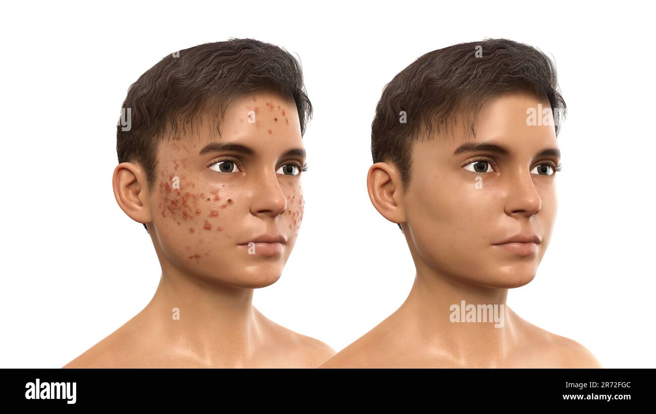 Acne vulgaris on a teenage boy's face, computer illustration showing ...