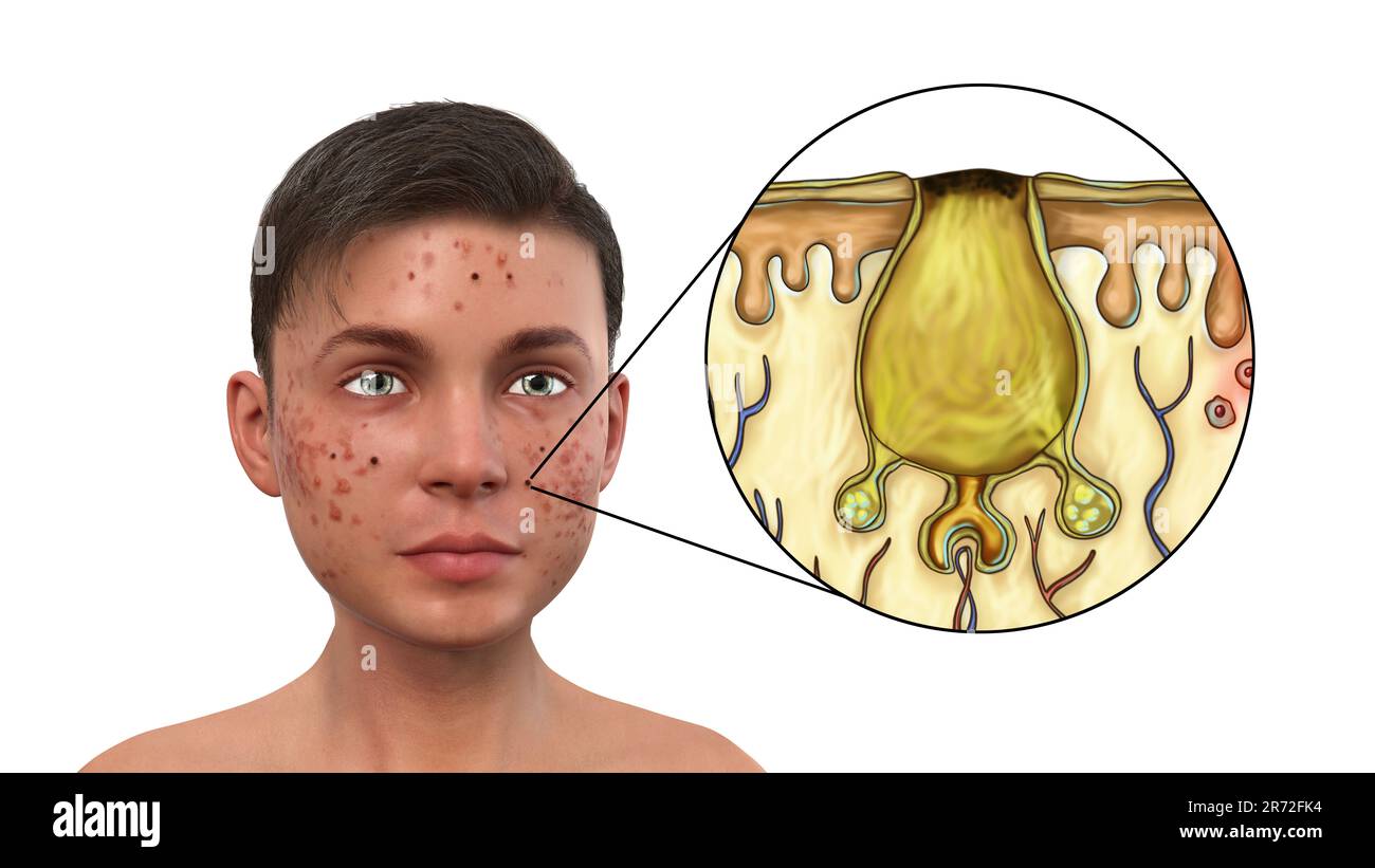 Acne vulgaris on a teenage boy's face and close-up view of the black ...