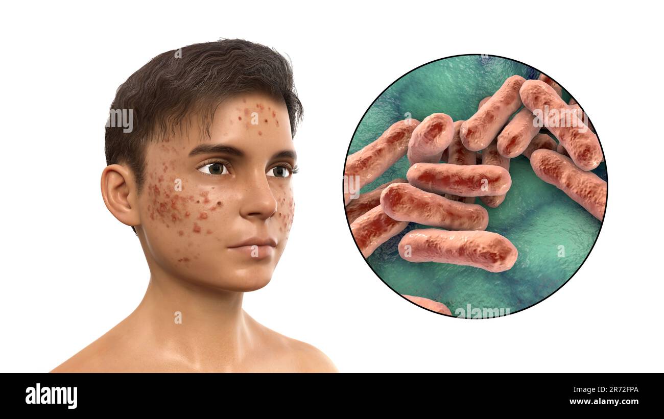 Acne vulgaris on a teenage boy's face and close-up view of bacteria ...