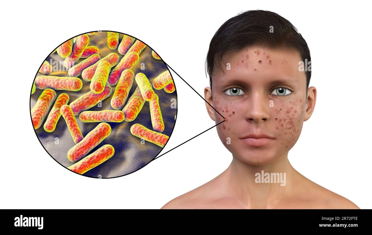 Acne vulgaris on a teenage boy's face and close-up view of bacteria ...