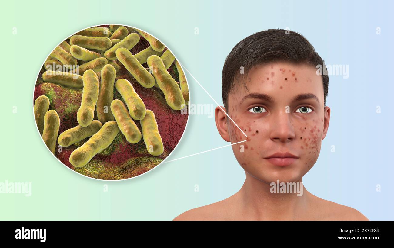 Acne vulgaris on a teenage boy's face and close-up view of bacteria ...