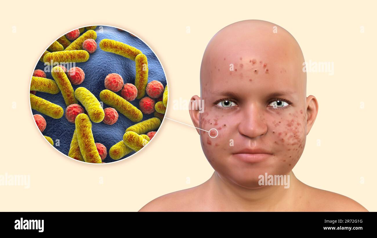 Acne vulgaris on an overweight teenage boy's face and close-up view of ...