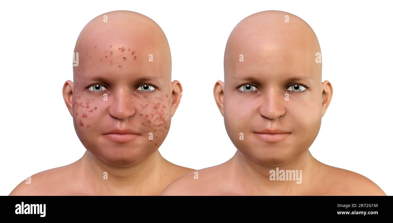 Acne vulgaris on an overweight teenage boy's face, computer ...