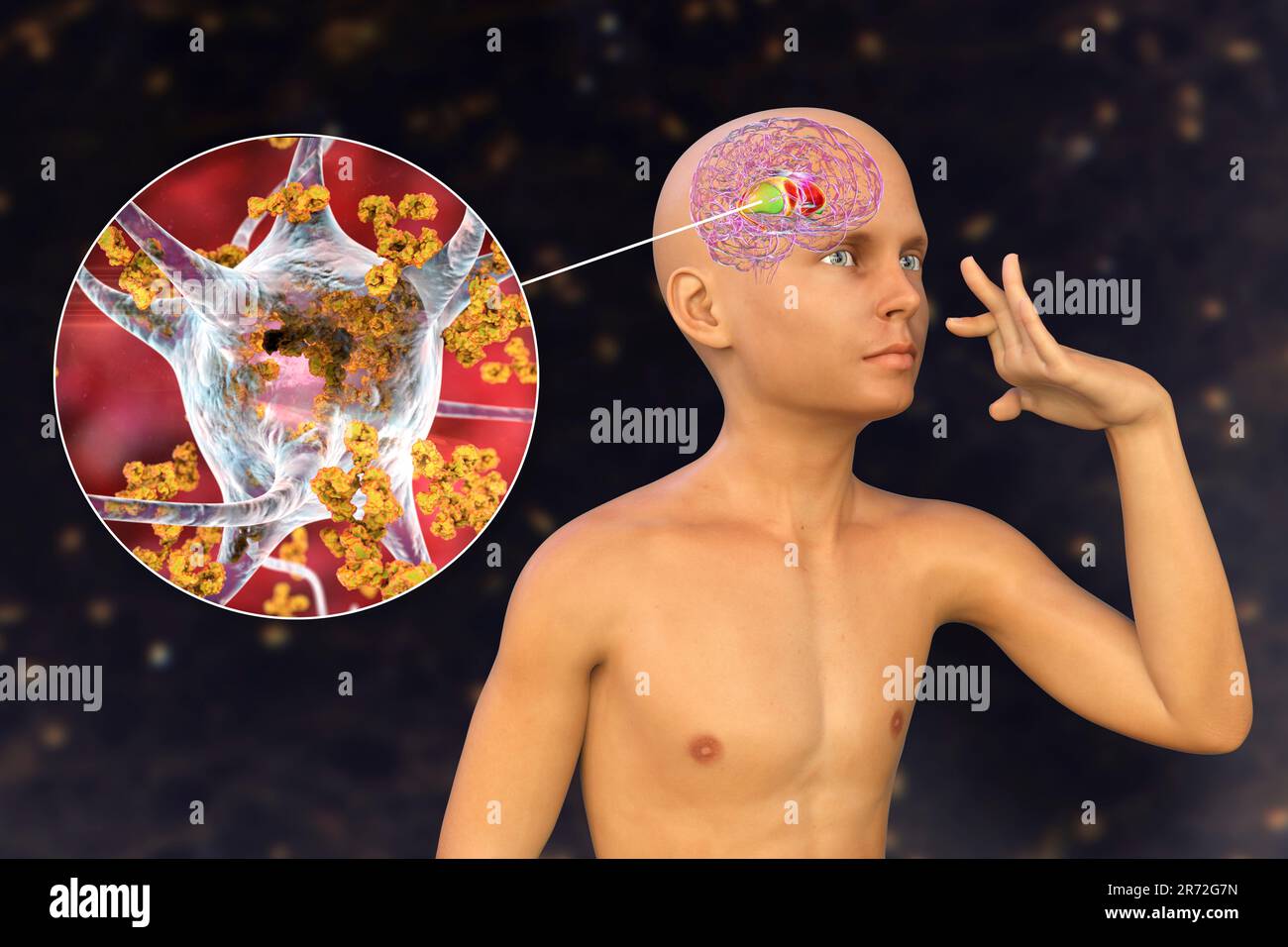 Sydenham's chorea, an autoimmune disease that results from ...