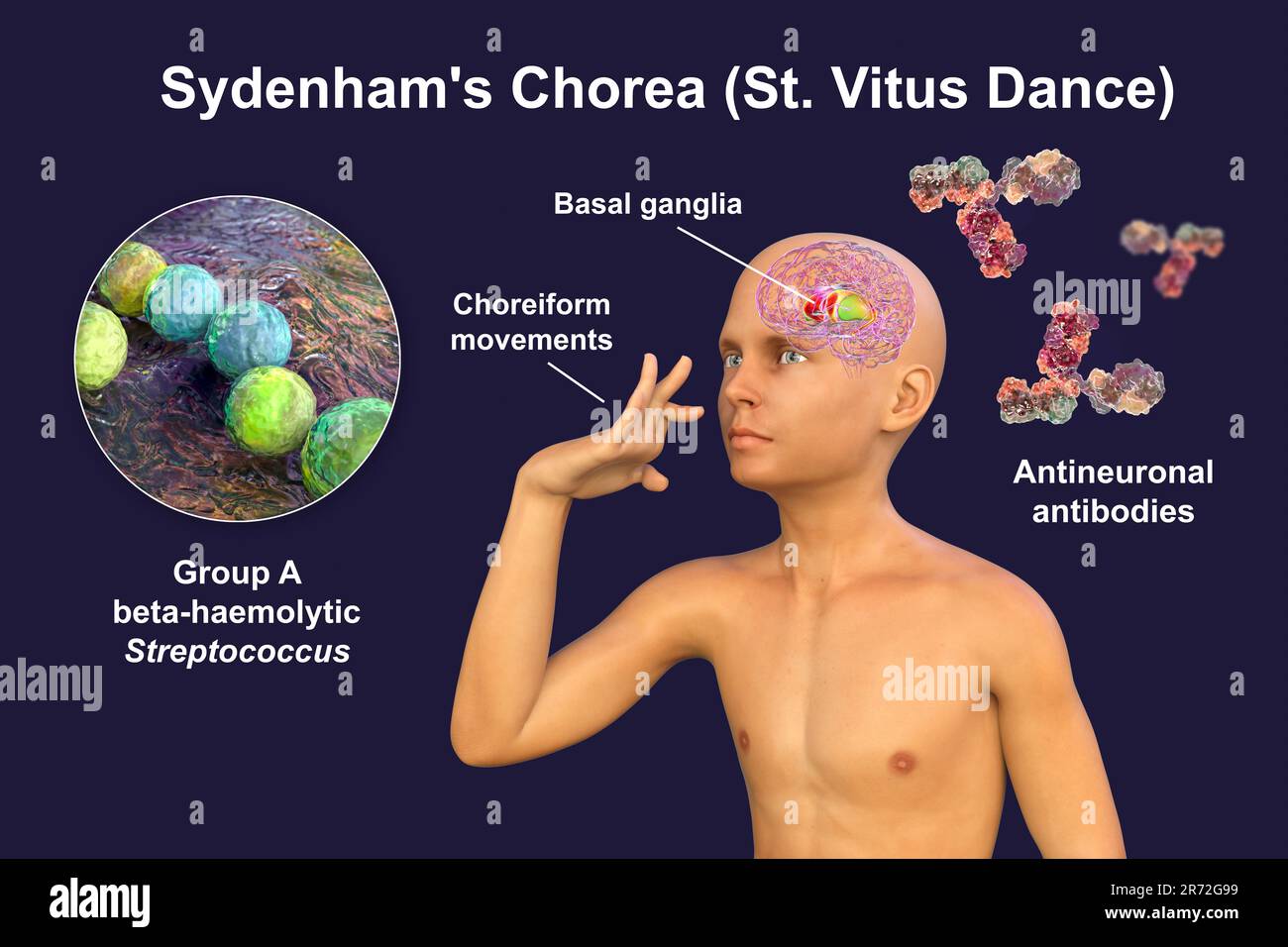 Sydenham's chorea, an autoimmune disease that results from ...