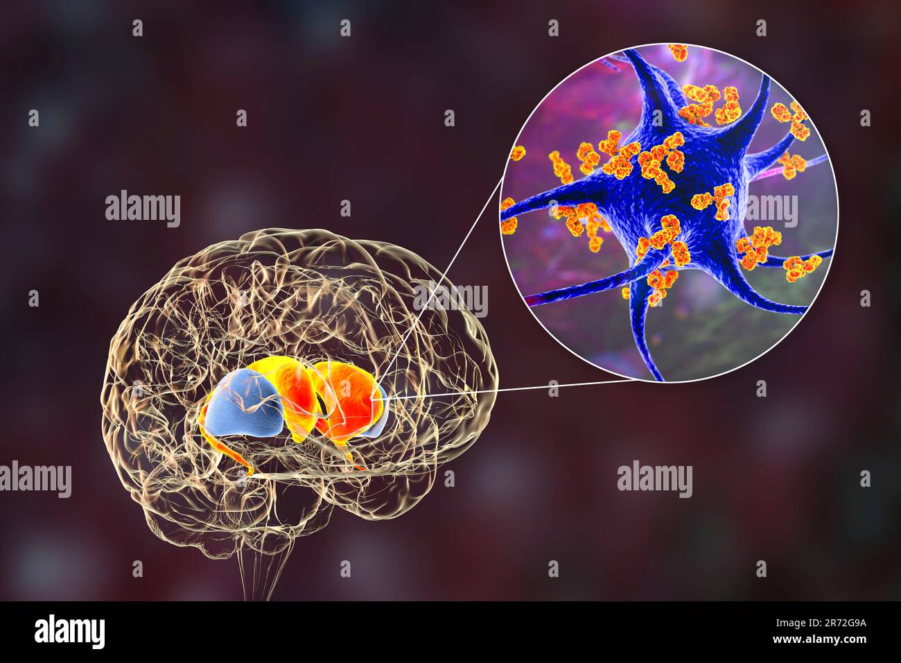 Anti-basal ganglia antibodies (ABGA). Conceptual computer illustration ...
